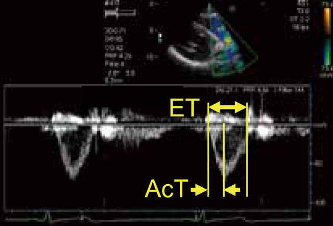 平均肺動脈圧心エコー 求め方 – 心エコー 取り方 測定法 – QDWJAE