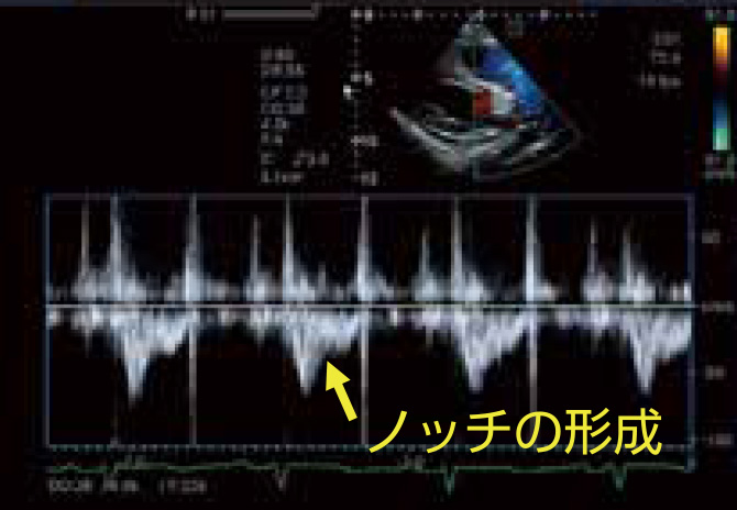 右心は評価していますか？｜肺高血圧症 疾患情報－領域／疾患情報｜日本新薬株式会社